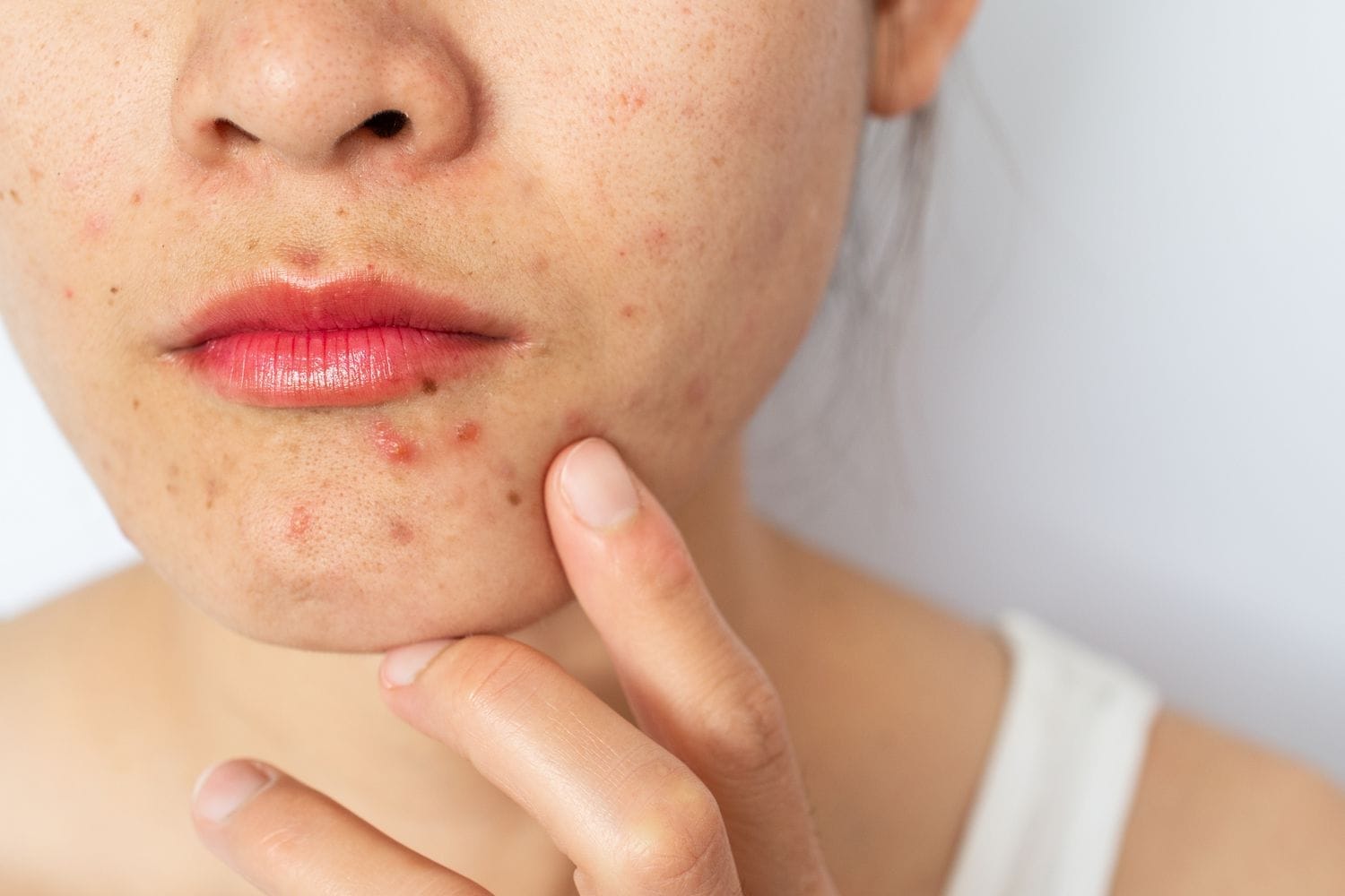 Laser acne treatment - Crystal MC